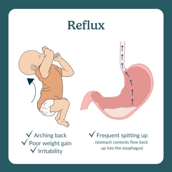 reflux - Breastfeeding Glossary by The Lactation Collection