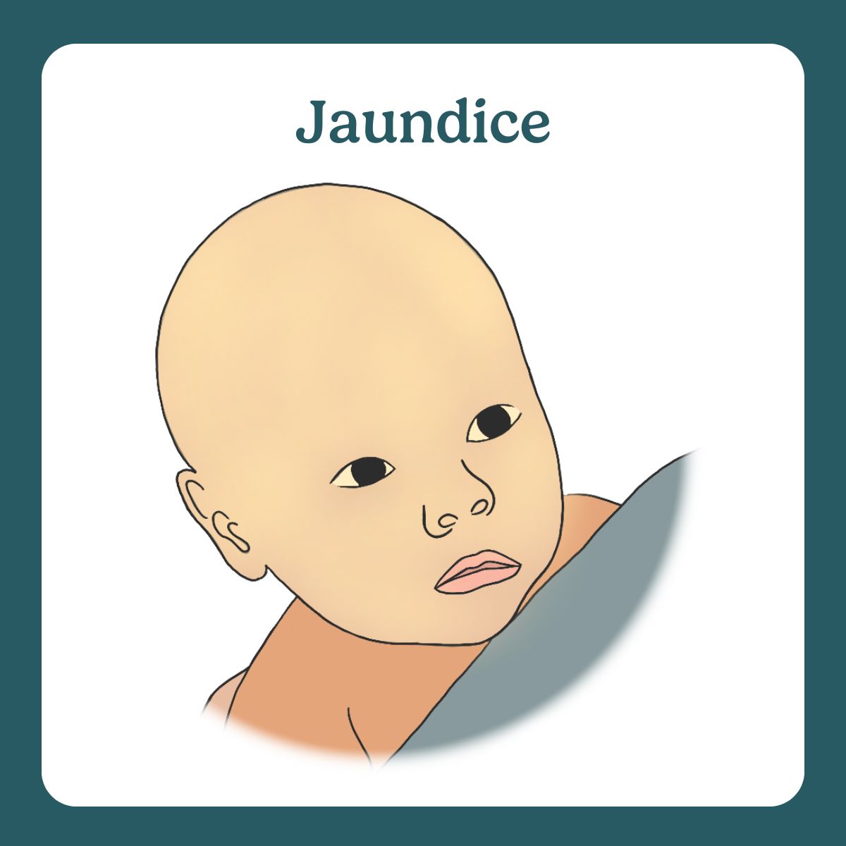jaundice - Breastfeeding Glossary by The Lactation Collection